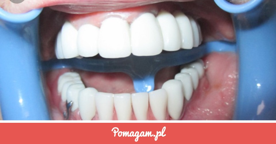 Zrzutka na Nowe Zęby dla Przyjaciółki - Przyjaciele Magdy | Pomagam.pl