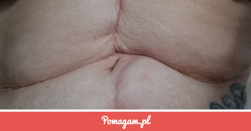 Zrzutka na Operacja Blizn Brzusznych - Hanna Ben Isa | Pomagam.pl