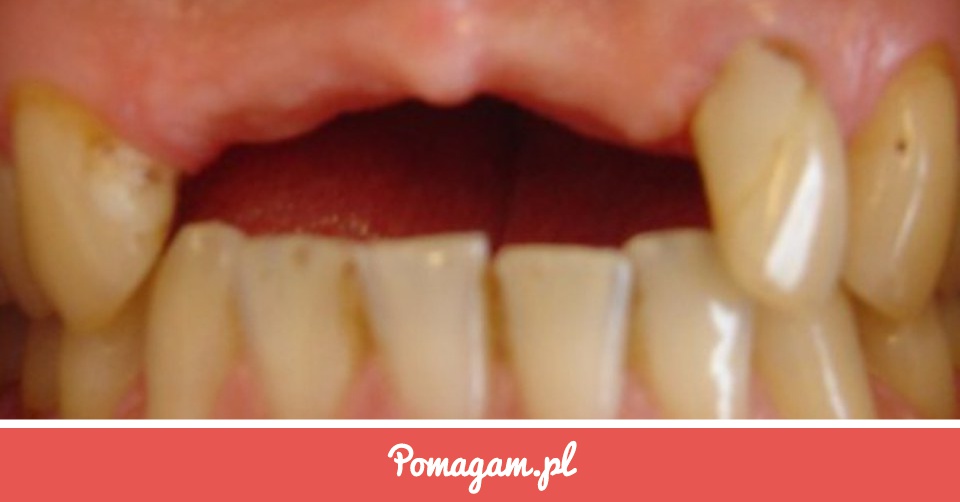 Zrzutka na Nowe zęby dla Mamy