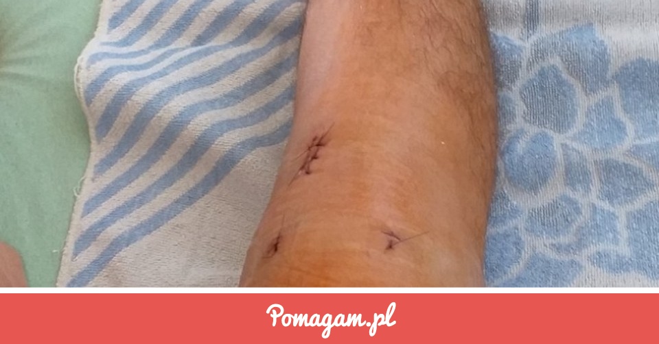 Zrzutka na Rehabilitacja po operacji ACL - Makary Górny | Pomagam.pl
